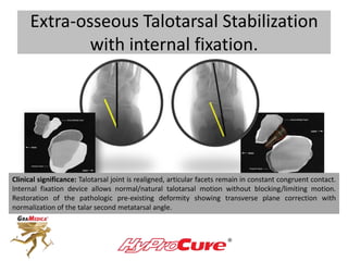 Understanding Talotarsal Displacement | PPT