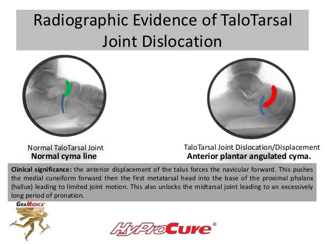 Understanding Talotarsal Displacement