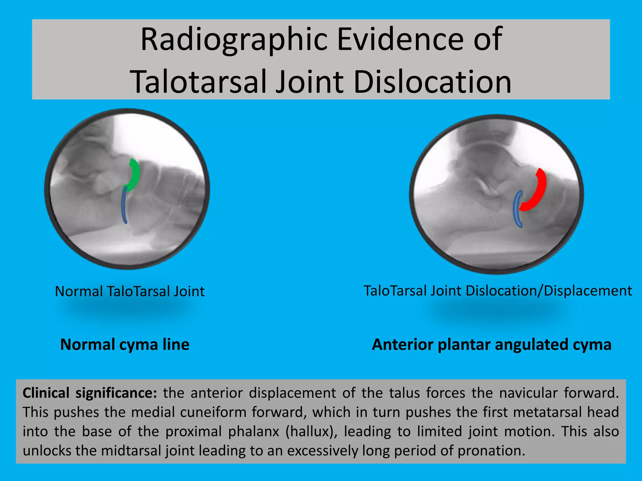 What is Talotarsal Joint Dislocation? | PPTX