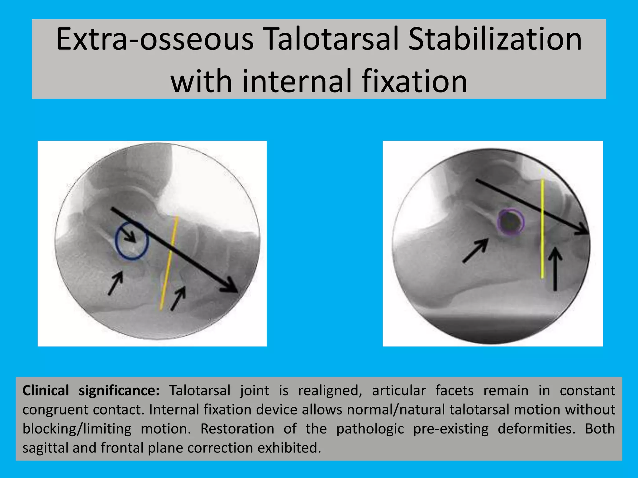What is Talotarsal Joint Dislocation? | PPTX