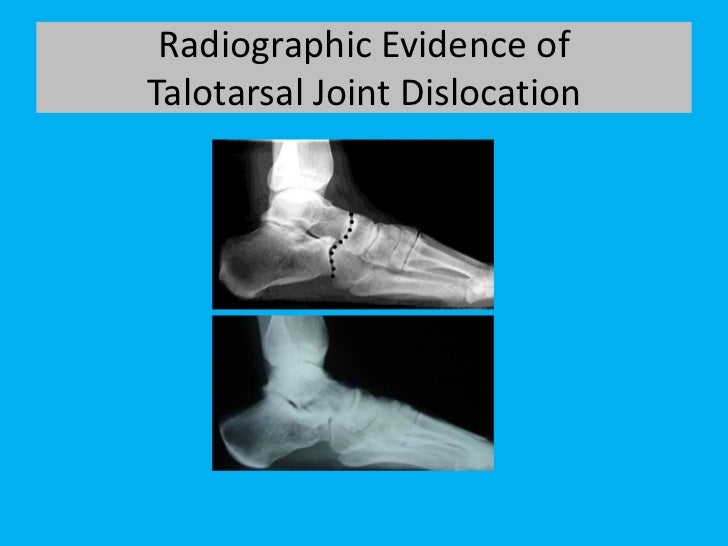 What is Talotarsal Joint Dislocation?