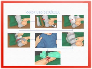 ESGUINCES, FRACTURAS E INMOVILIZACIONES | PPTX