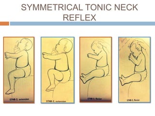 Primitive And Tonic Reflexes | PPTX