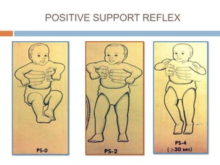 Primitive And Tonic Reflexes | PPT