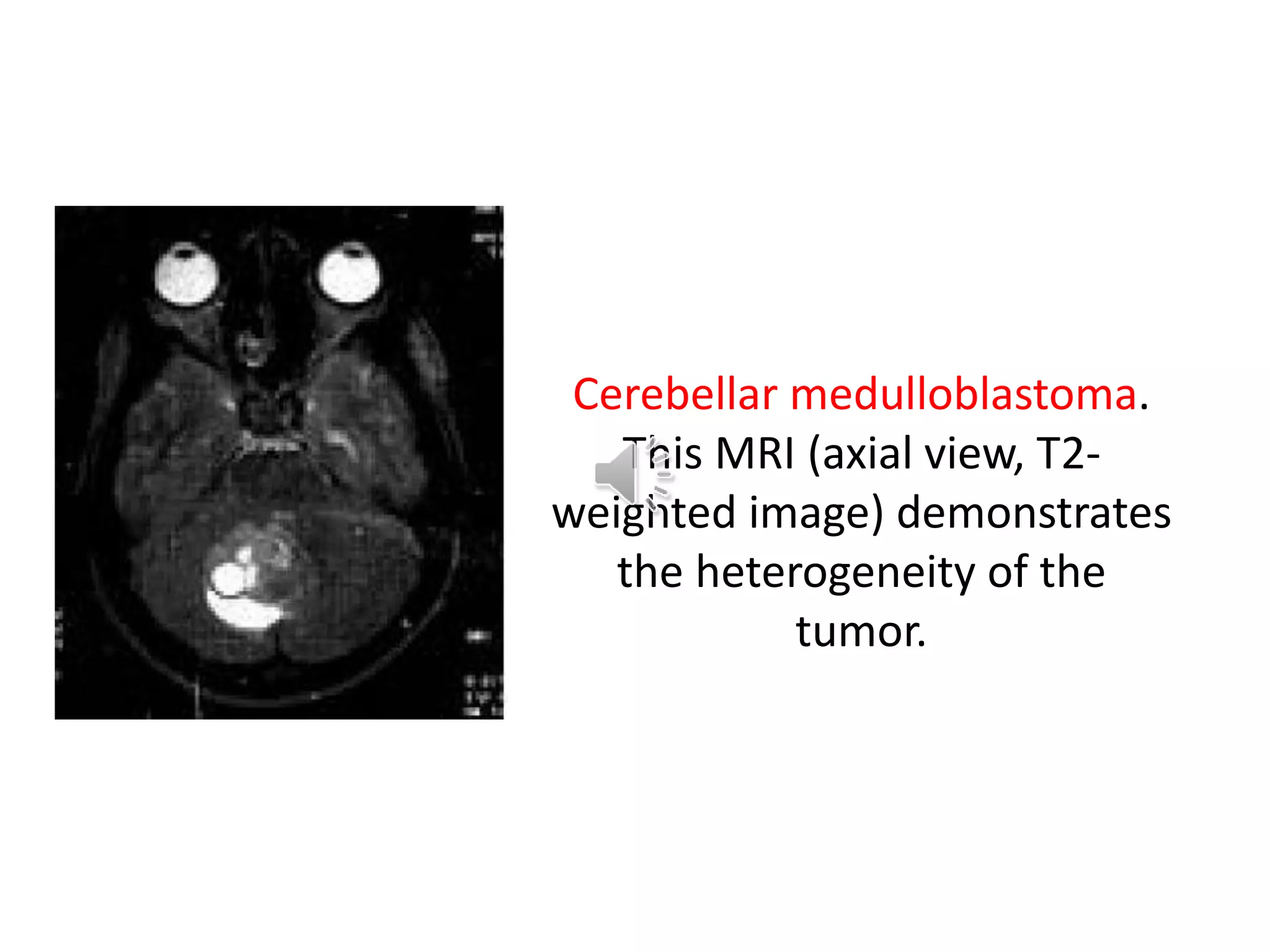 Primitive Neuroectodermal Tumor Pptx