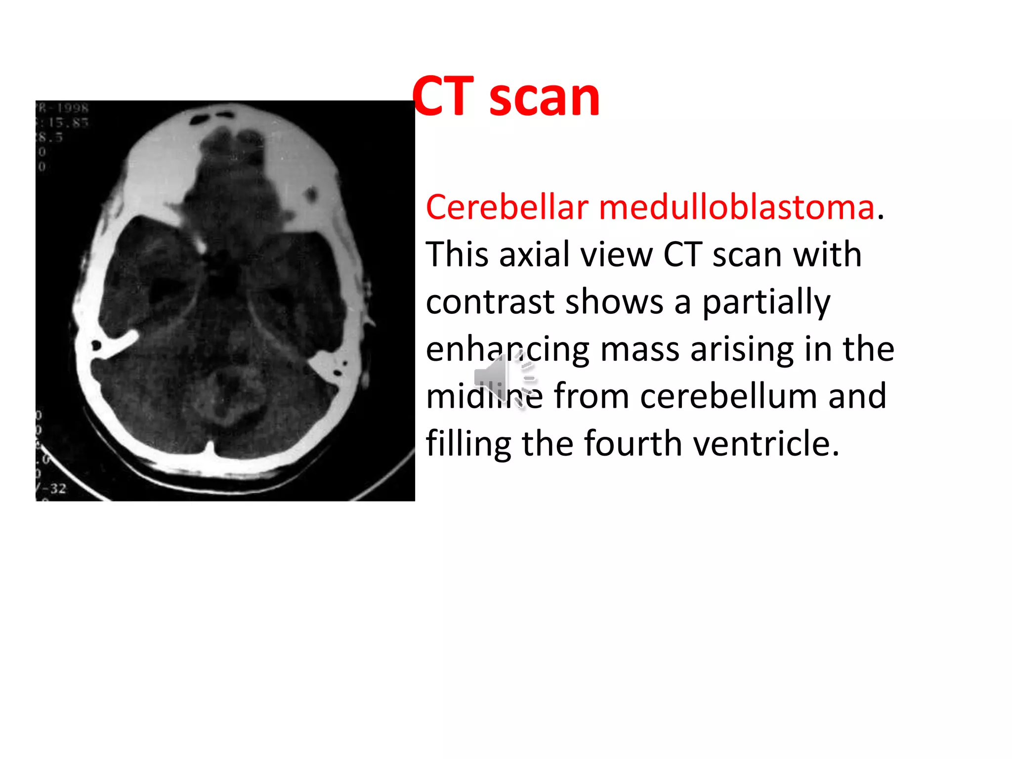 Primitive Neuroectodermal Tumor Pptx