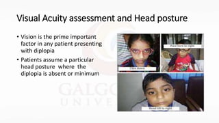 Prince investigation in paralytic strabismus | PPT