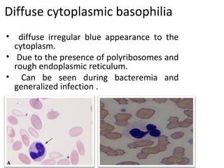 Diffusely Basophilic Erythrocyte