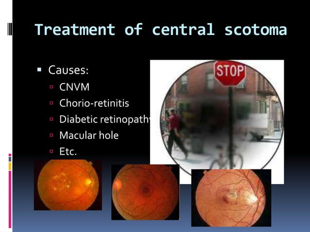 Princibles of low vision aids 2020 | PPT