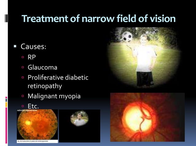 Princibles of low vision aids 2020 | PPT