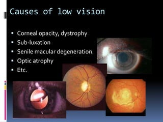 Princibles of low vision aids 2020 | PPT | Free Download