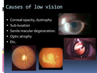 Princibles of low vision aids .pptx