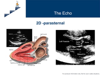 Principal basics of the echocardiogram diastolic dysfunction and left ...