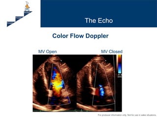 Principal basics of the echocardiogram diastolic dysfunction and left ventricular hypertrophy | PPT