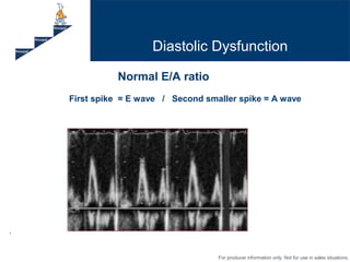 Principal basics of the echocardiogram diastolic dysfunction and left ...