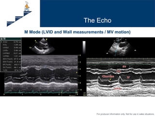 Principal basics of the echocardiogram diastolic dysfunction and left ...