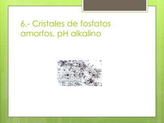 Principales cristales en orinas | PPTX