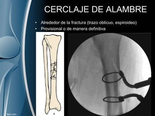 Principales métodos de osteosíntesis | PPTX