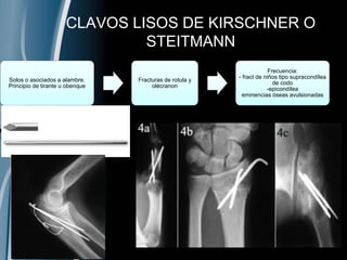 Principales métodos de osteosíntesis | PPTX