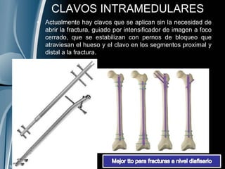 Principales métodos de osteosíntesis | PPTX