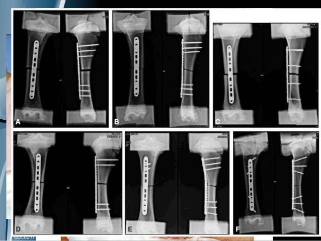 Principales métodos de osteosíntesis