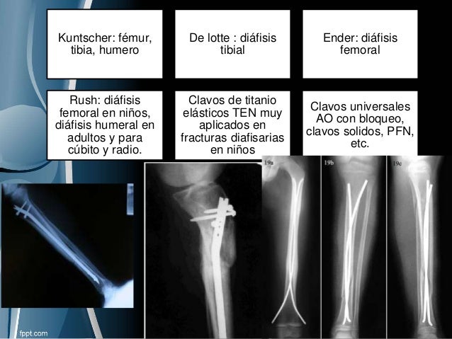Principales métodos de osteosíntesis