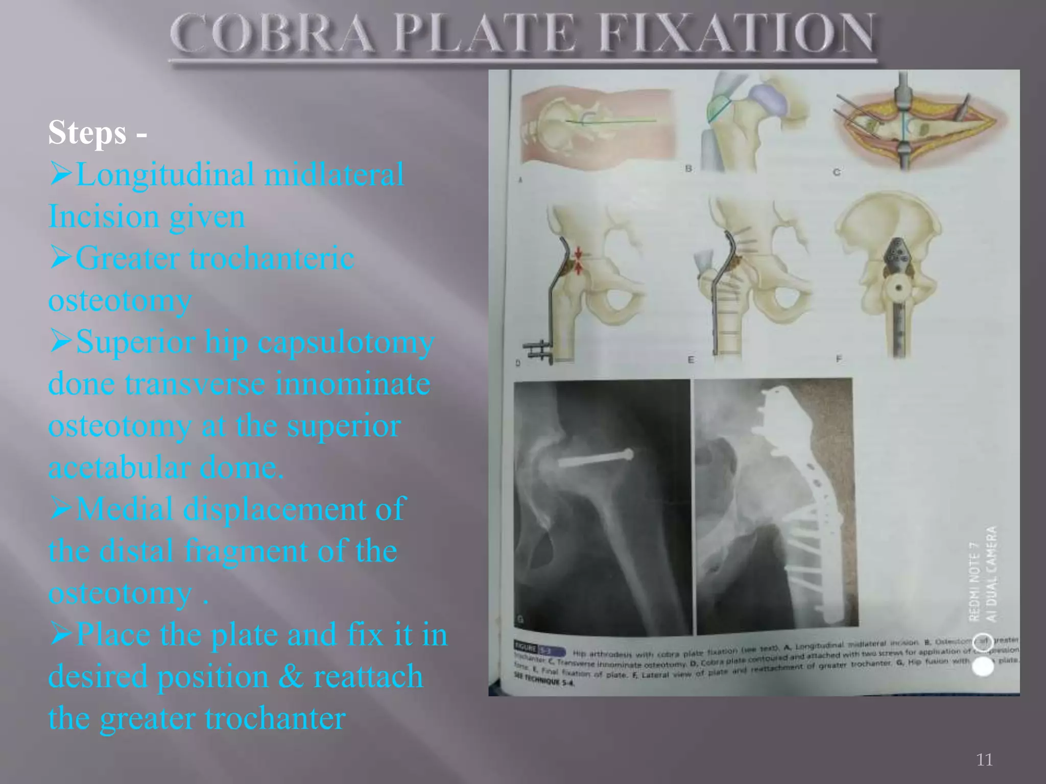 Principal of arthrodesis | PPTX