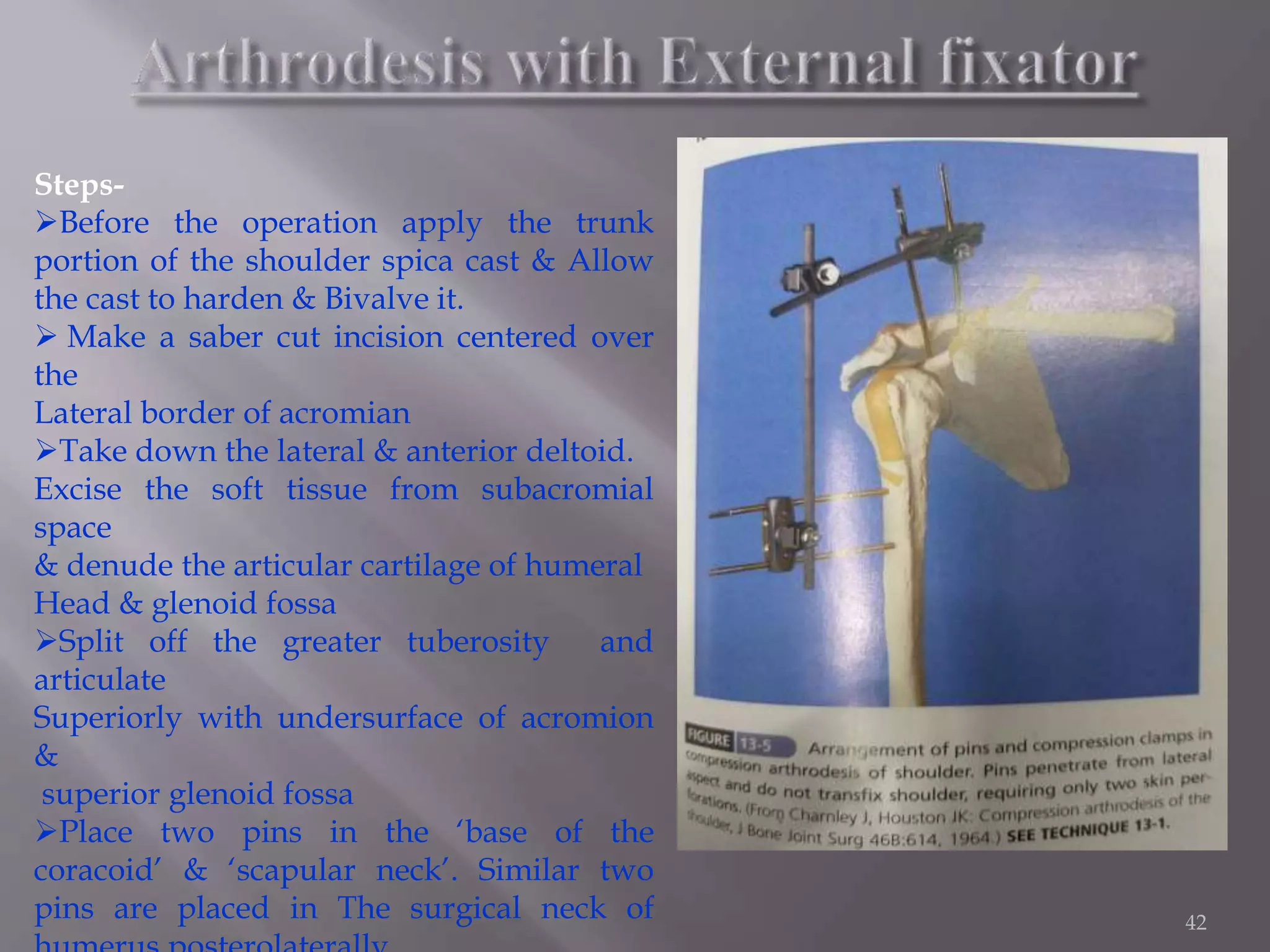 Principal of arthrodesis | PPTX
