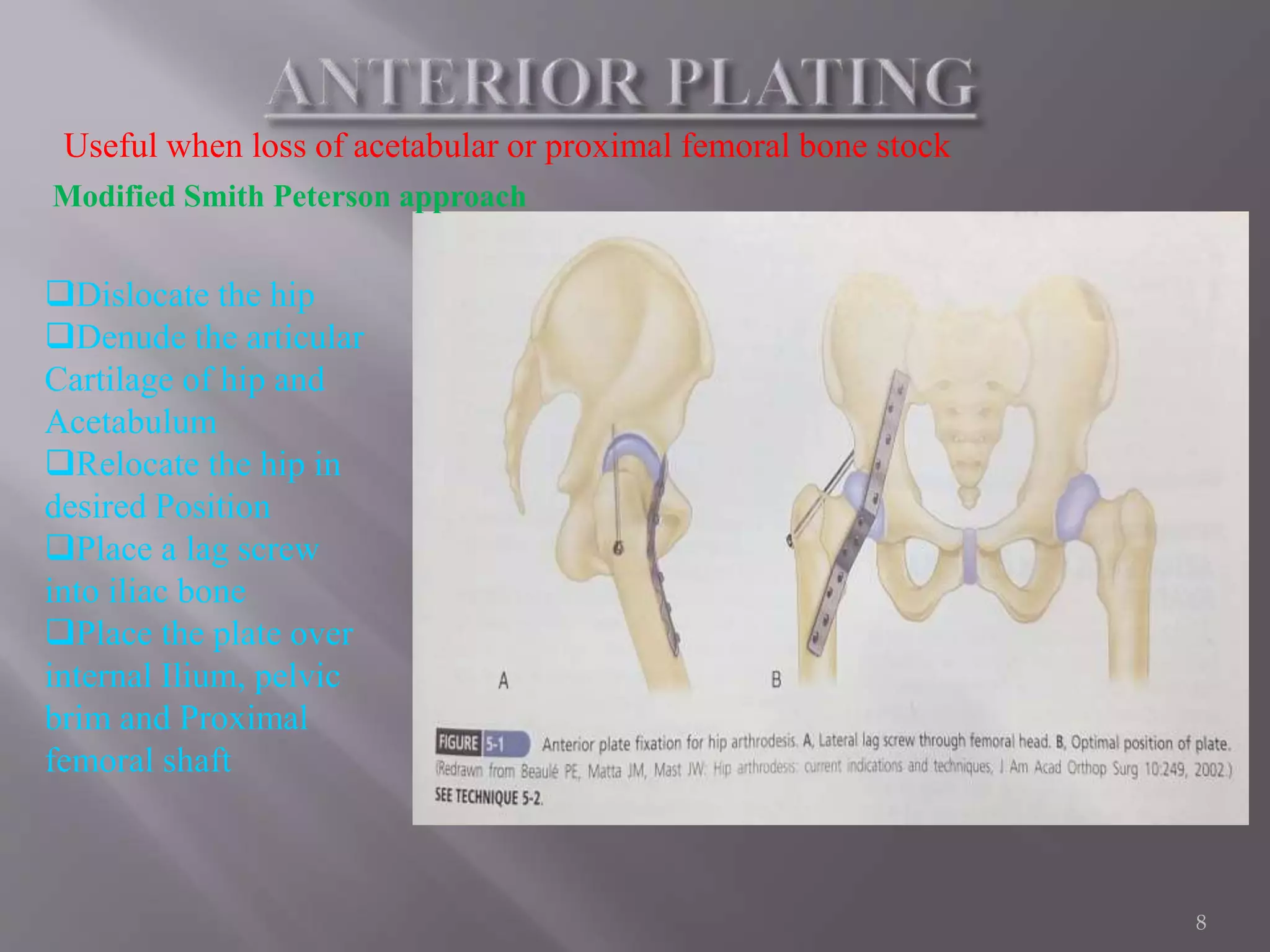 Principal of arthrodesis | PPTX