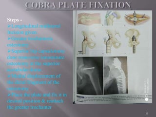 Principal of arthrodesis | PPTX