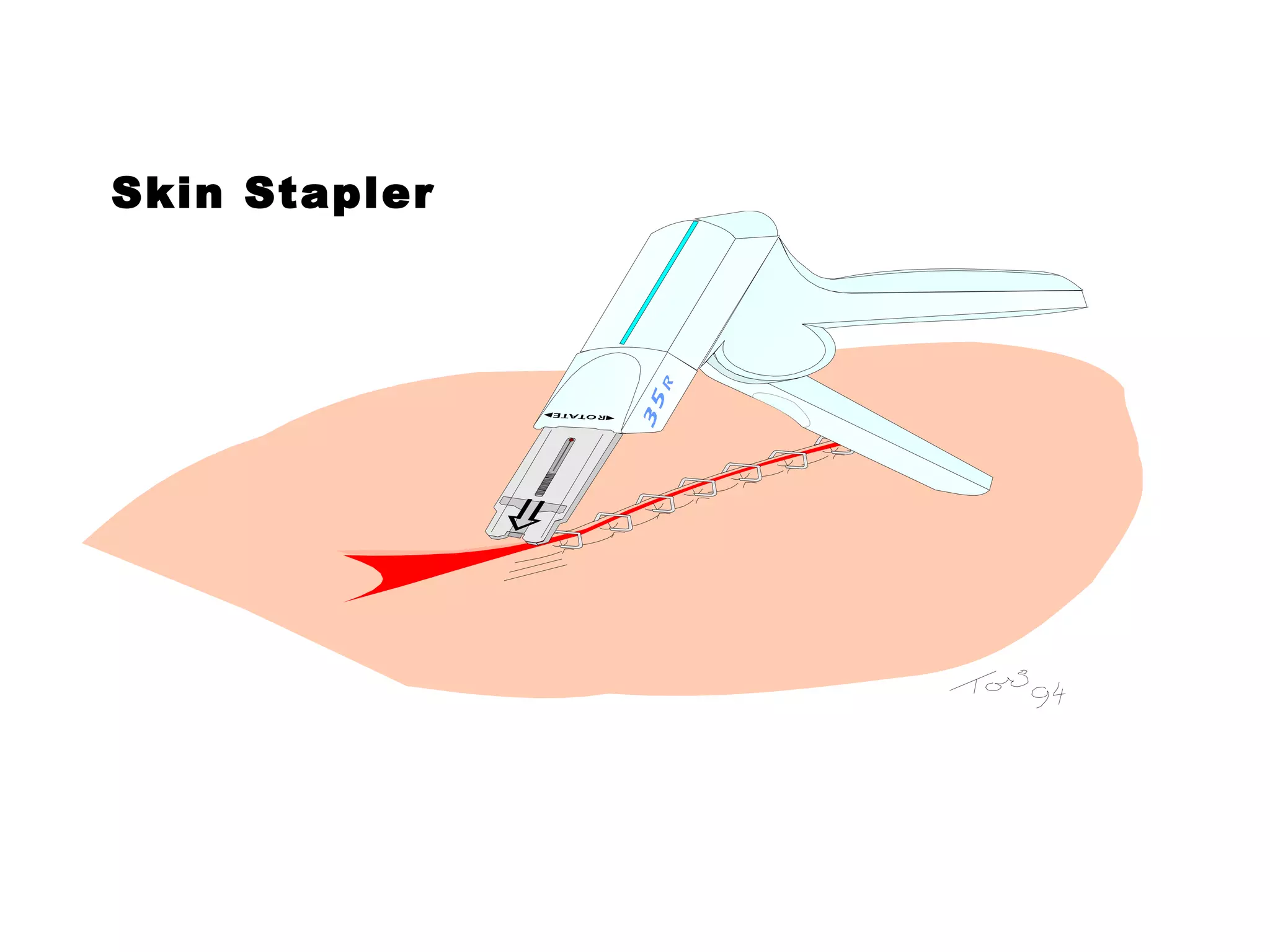Laproscopic surgery | PPT