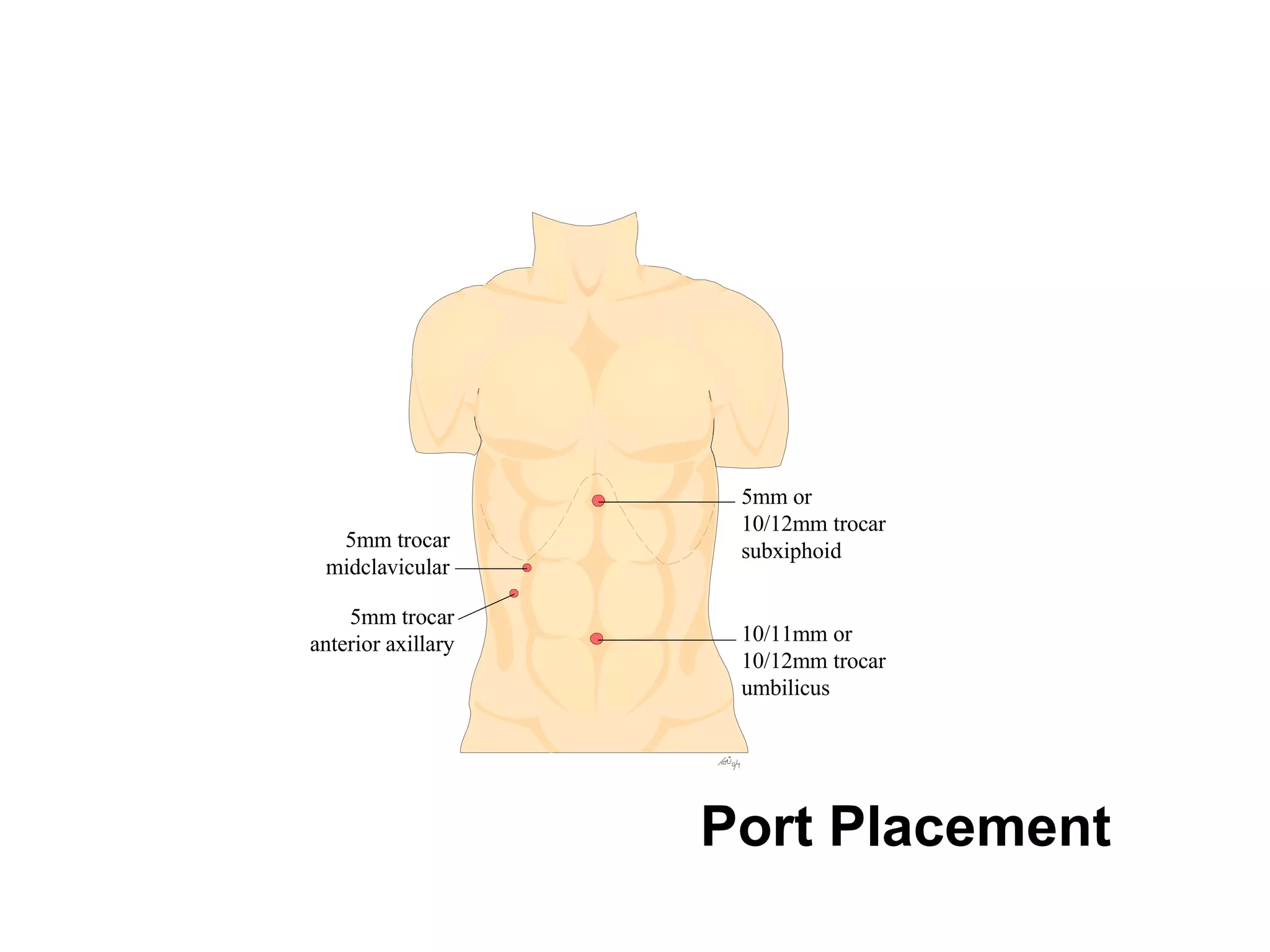Laproscopic surgery | PPT