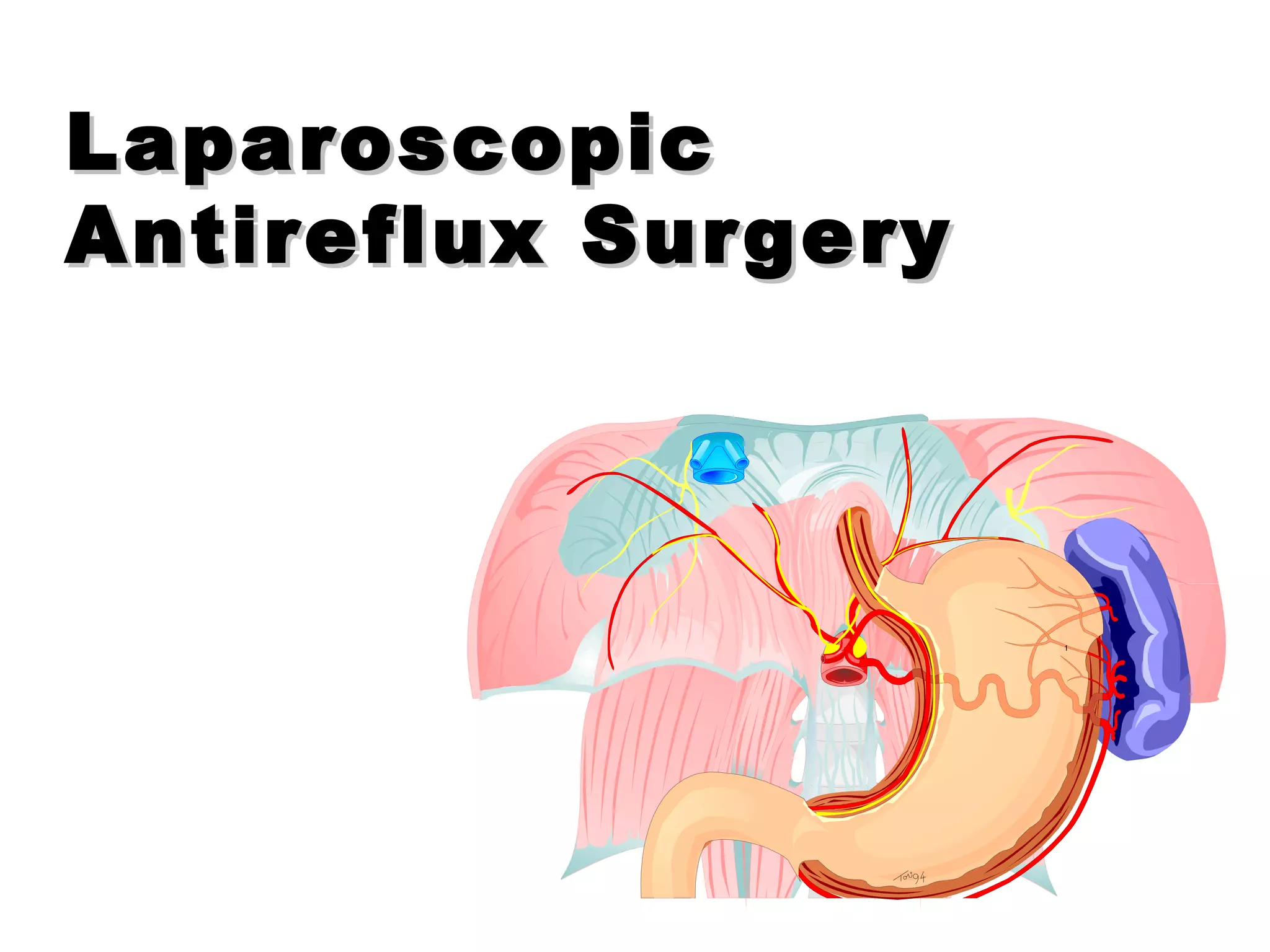 Laproscopic surgery | PPT