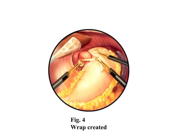 Laproscopic surgery | PPT