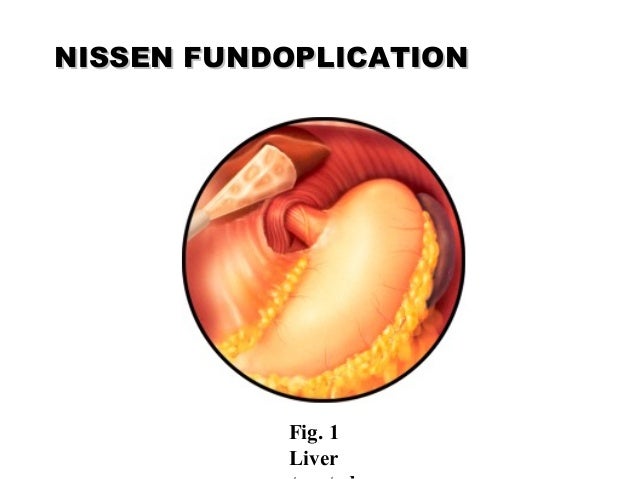 Laproscopic Surgery