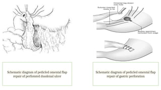 Principals of management of Gastro-Intestinal tract perforation.pptx