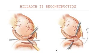 Principes of gastrectomies | PPTX