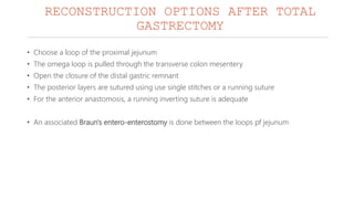 Principes of gastrectomies | PPTX