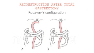 Total Gastrectomy With Roux En Y Esophagojejunostomy