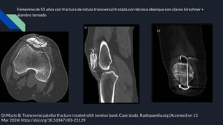 Principios biomecánicanicos. DE OSTEOSINTESISpptx | PPTX