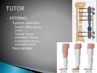 PRINCIPIOS BIOMECANICOS DE OSTEOSINTESIS DE FRACTURAS.pptx