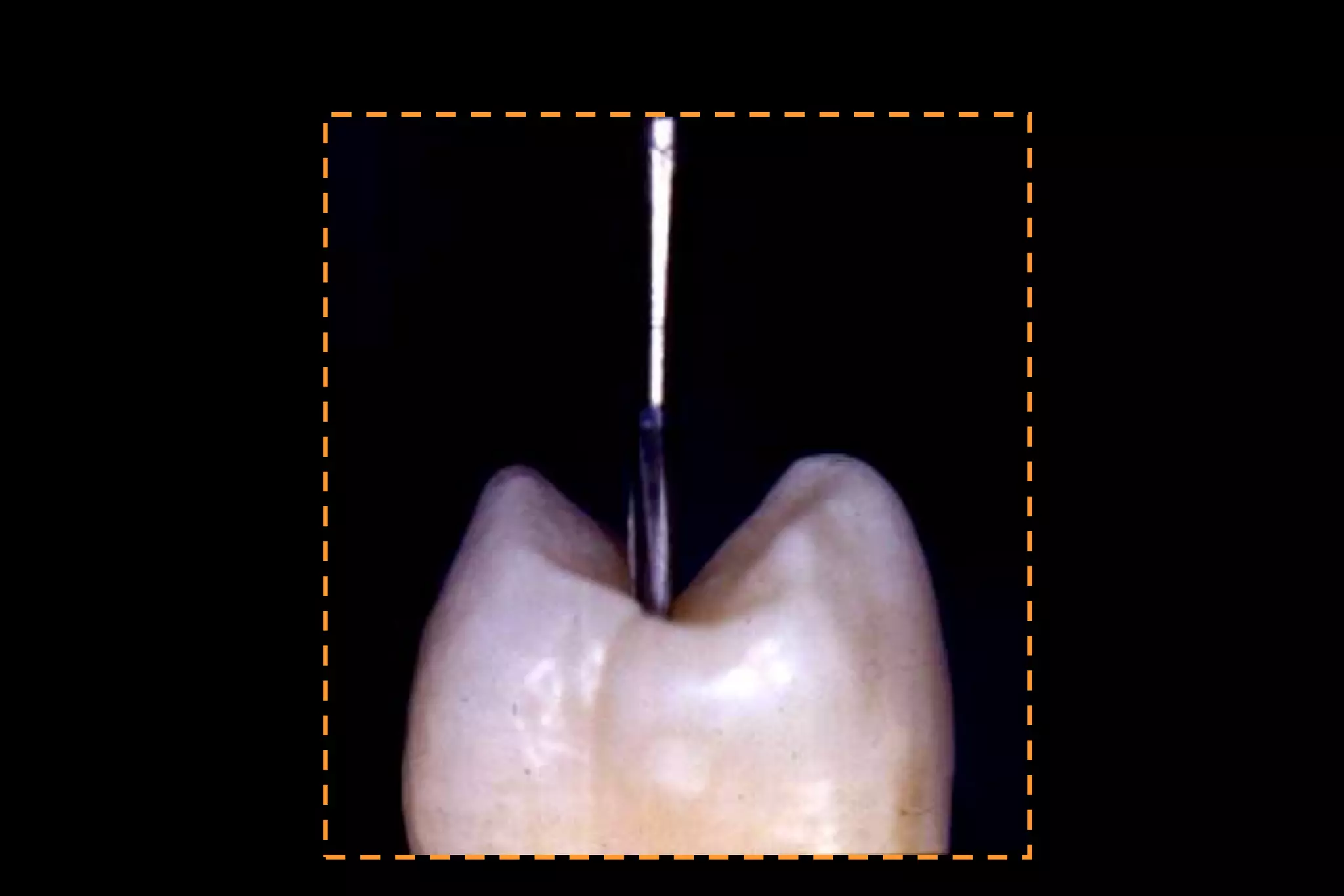 Principios gerais do preparo cavitário