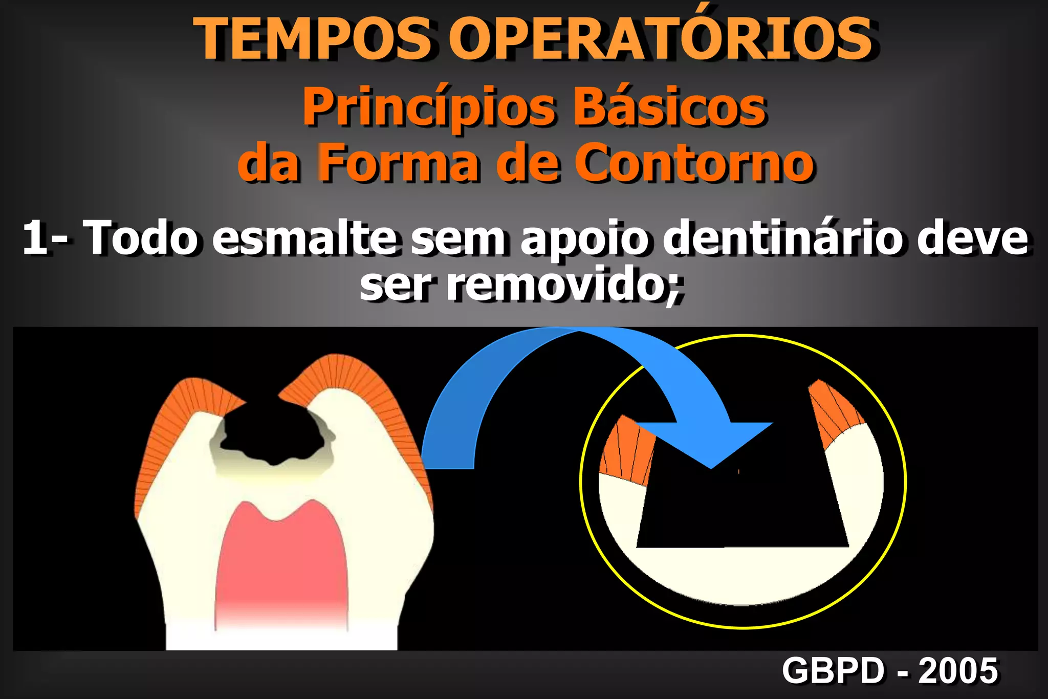 Principios gerais do preparo cavitário