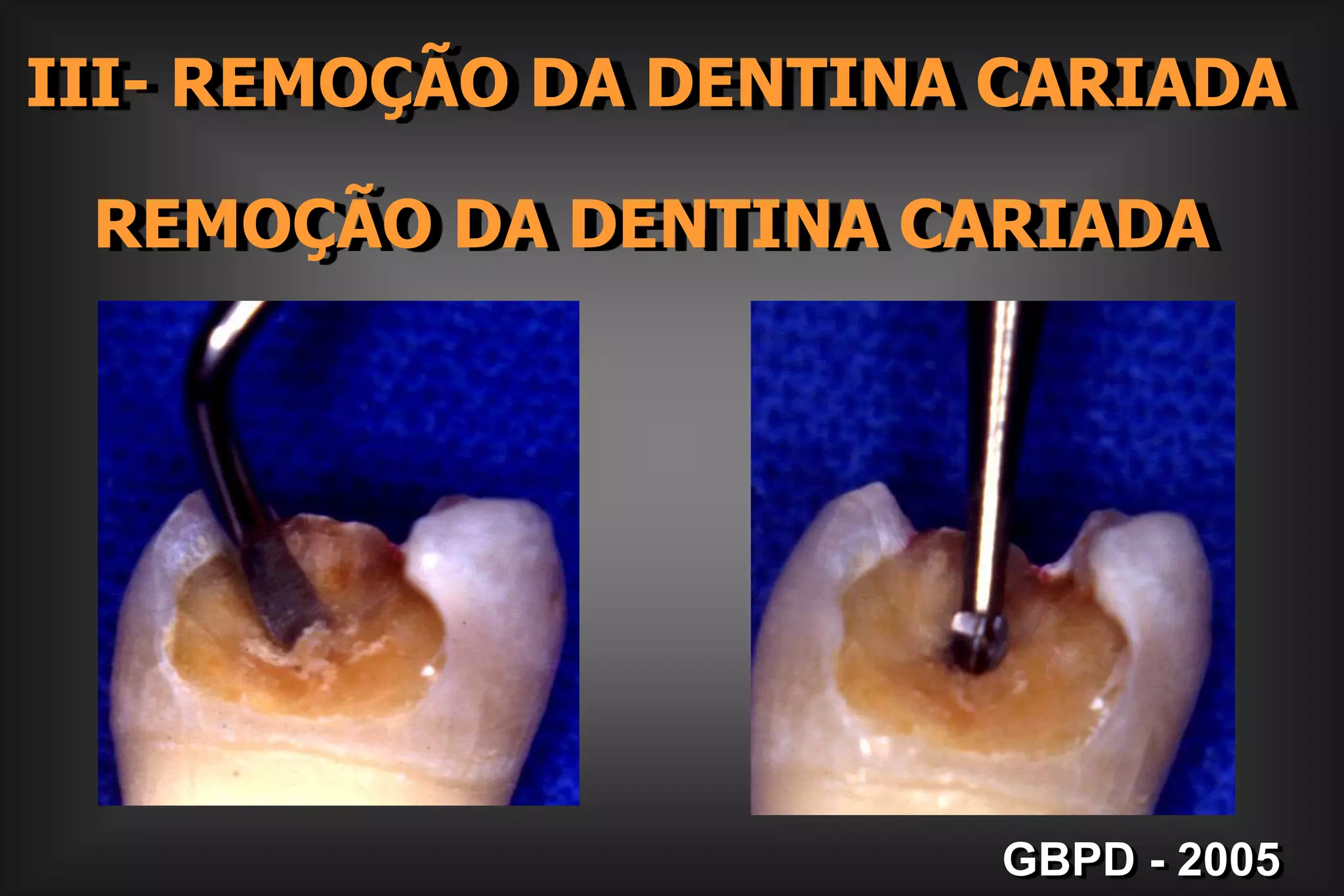 Principios gerais do preparo cavitário