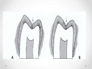 principle-2-stepes-of-cavity-preparation-5.ppt