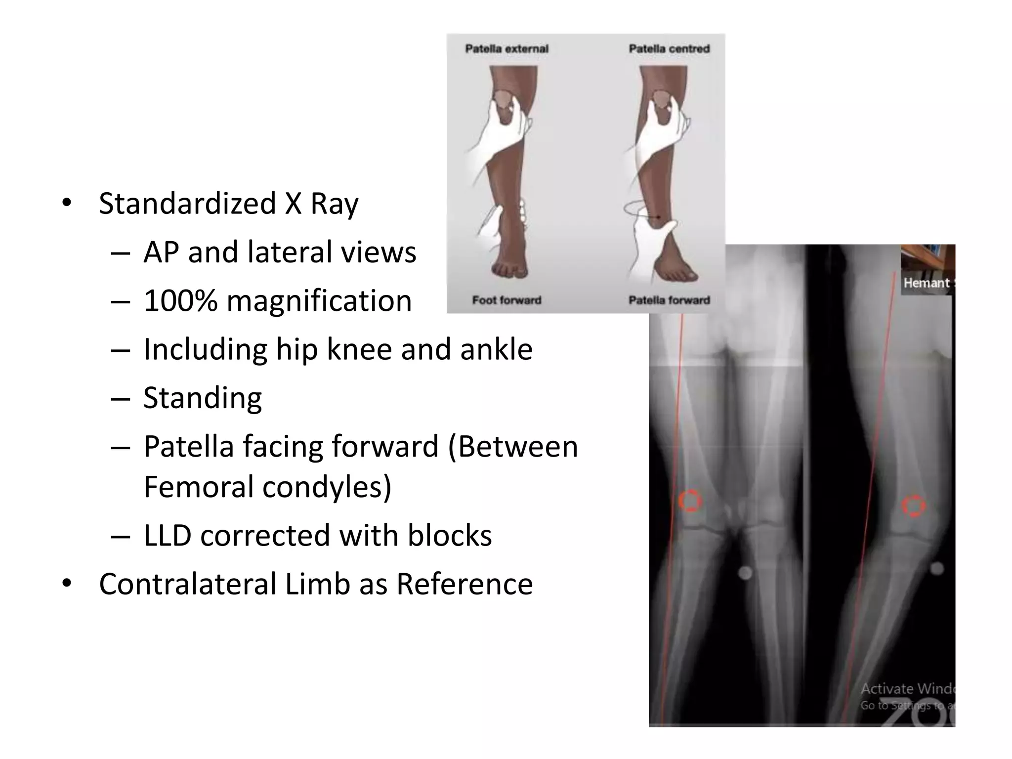 Principle of Deformity Correction in lower Limb | PPTX