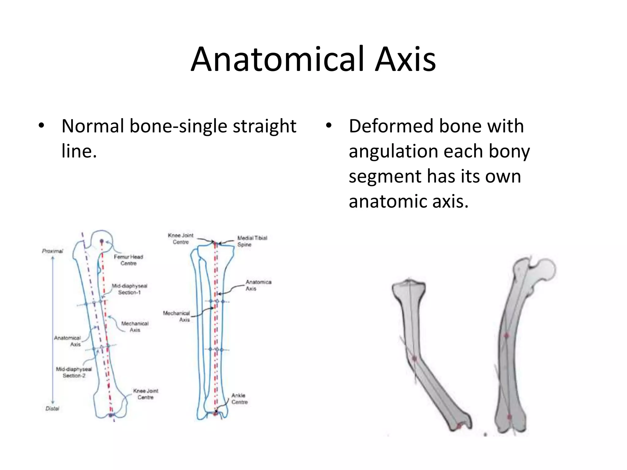 Principle of Deformity Correction in lower Limb | PPTX