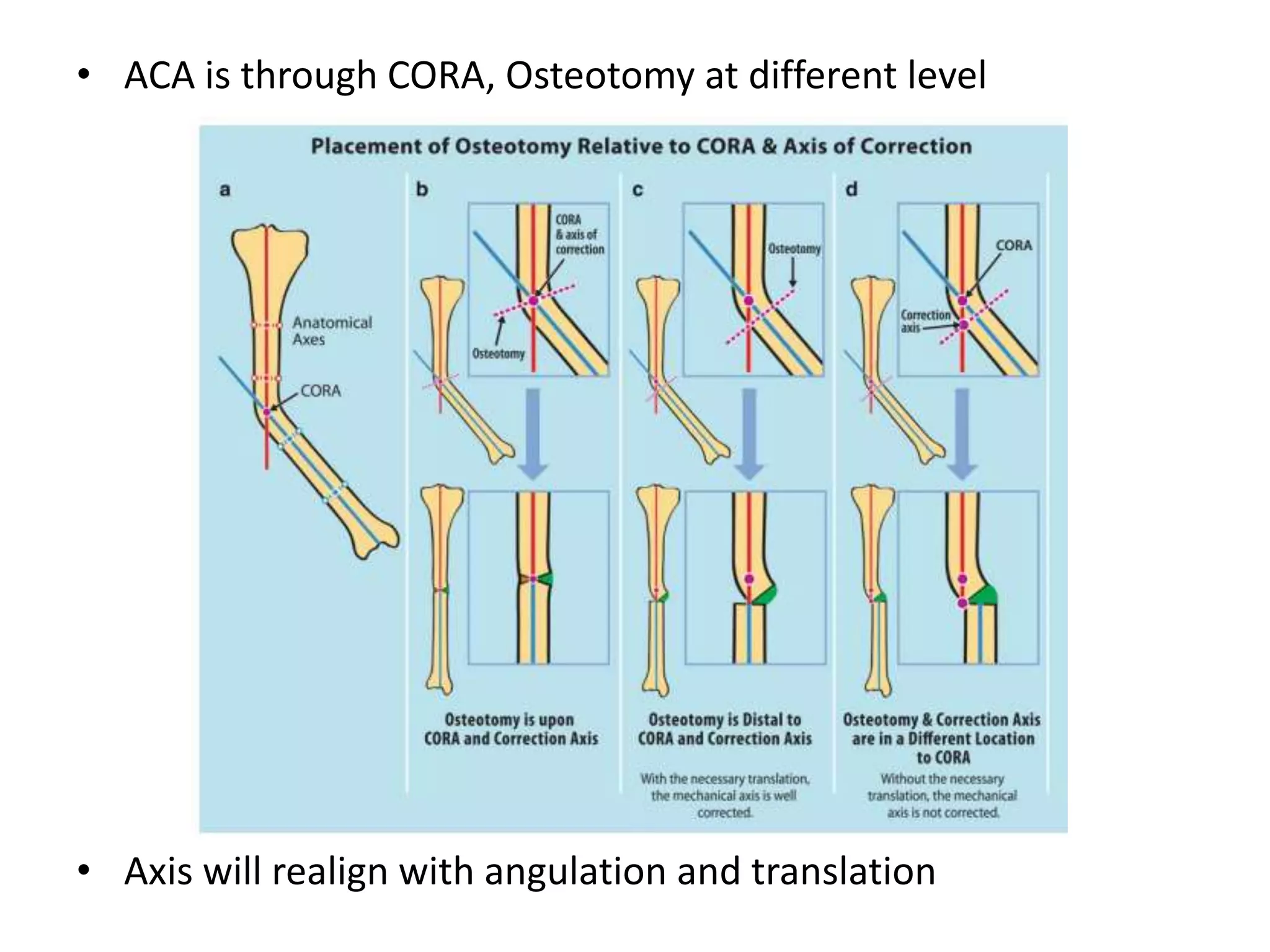 Principle of Deformity Correction in lower Limb | PPTX