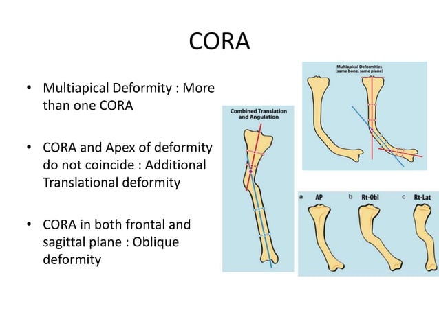 Principle of Deformity Correction in lower Limb | PPTX | Death, Injury, or Military Conflict ...