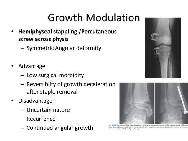 Principle of Deformity Correction in lower Limb | PPTX | Death, Injury ...